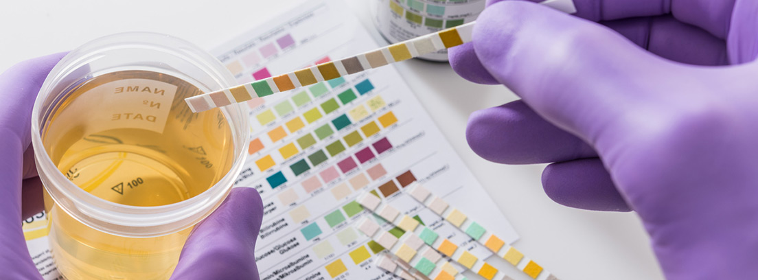 Microhematuria: el valor del microscopio – CLIP URBANO